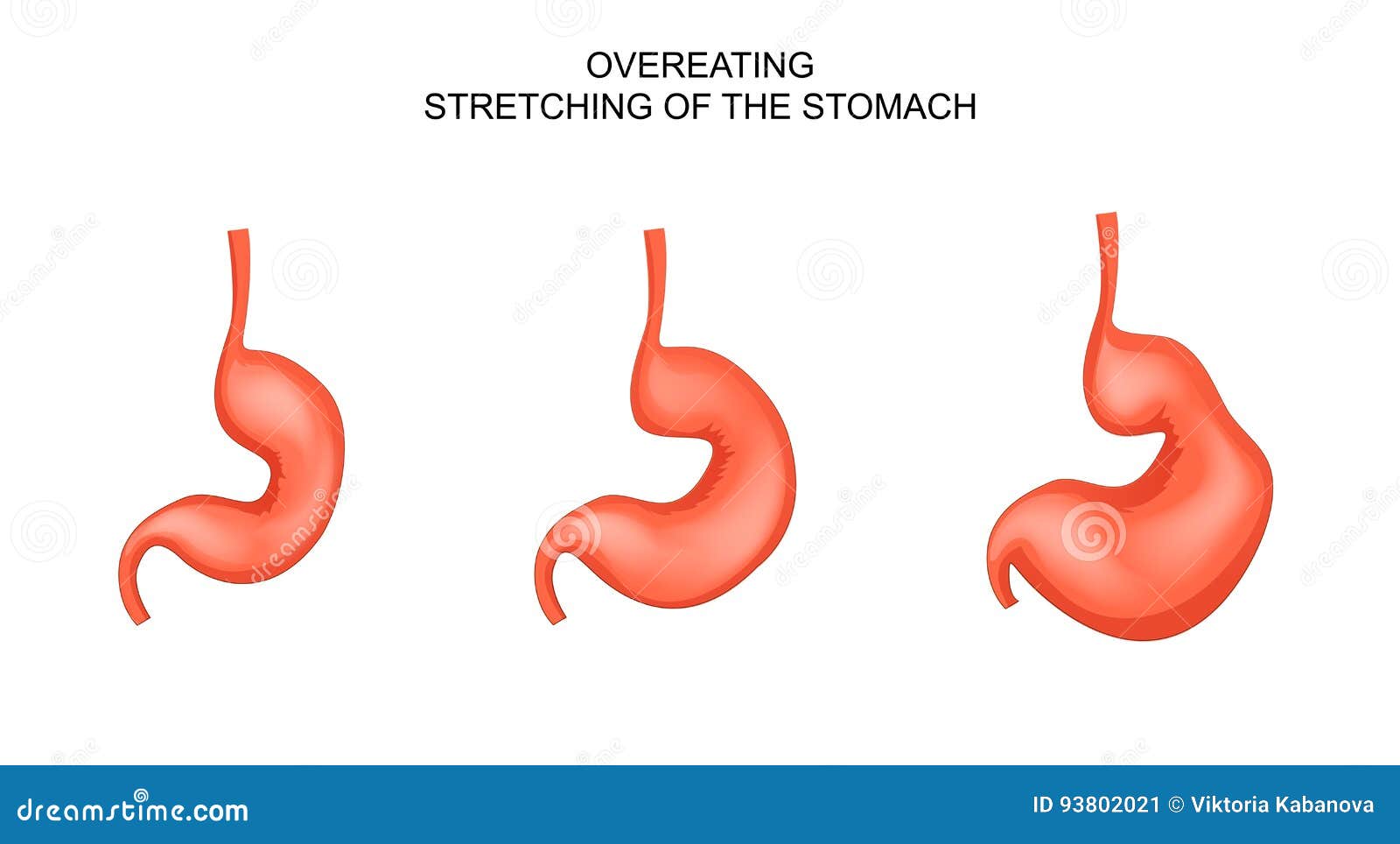 Lo Stomaco, Dilatato Dall'eccesso Di Cibo Illustrazione Vettoriale ...