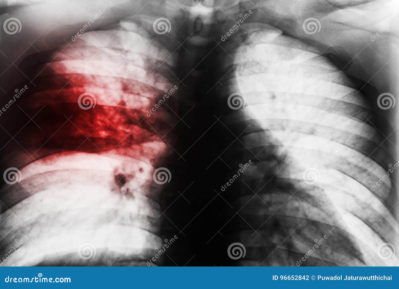 Lobaire longontsteking stock foto. Image of bacteriën - 96652842