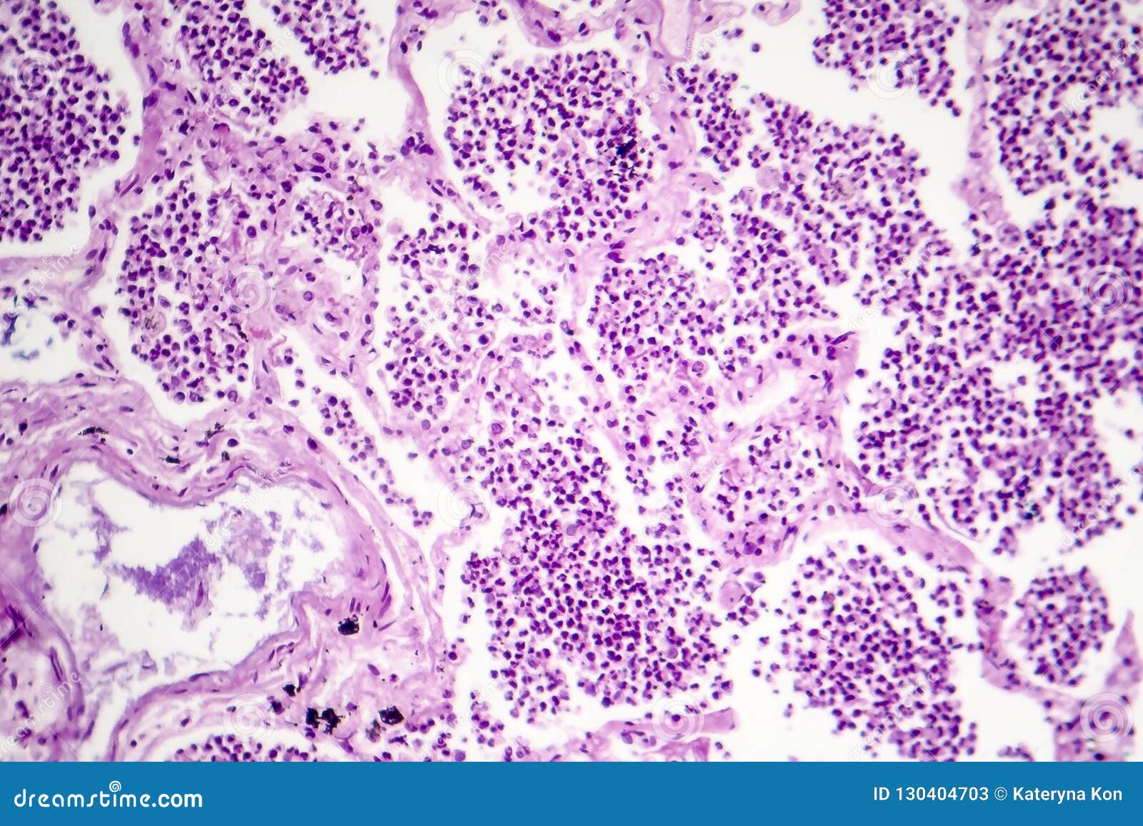 Lobar Pneumonia, Grey Hepatic Phase Stock Image - Image of cell ...