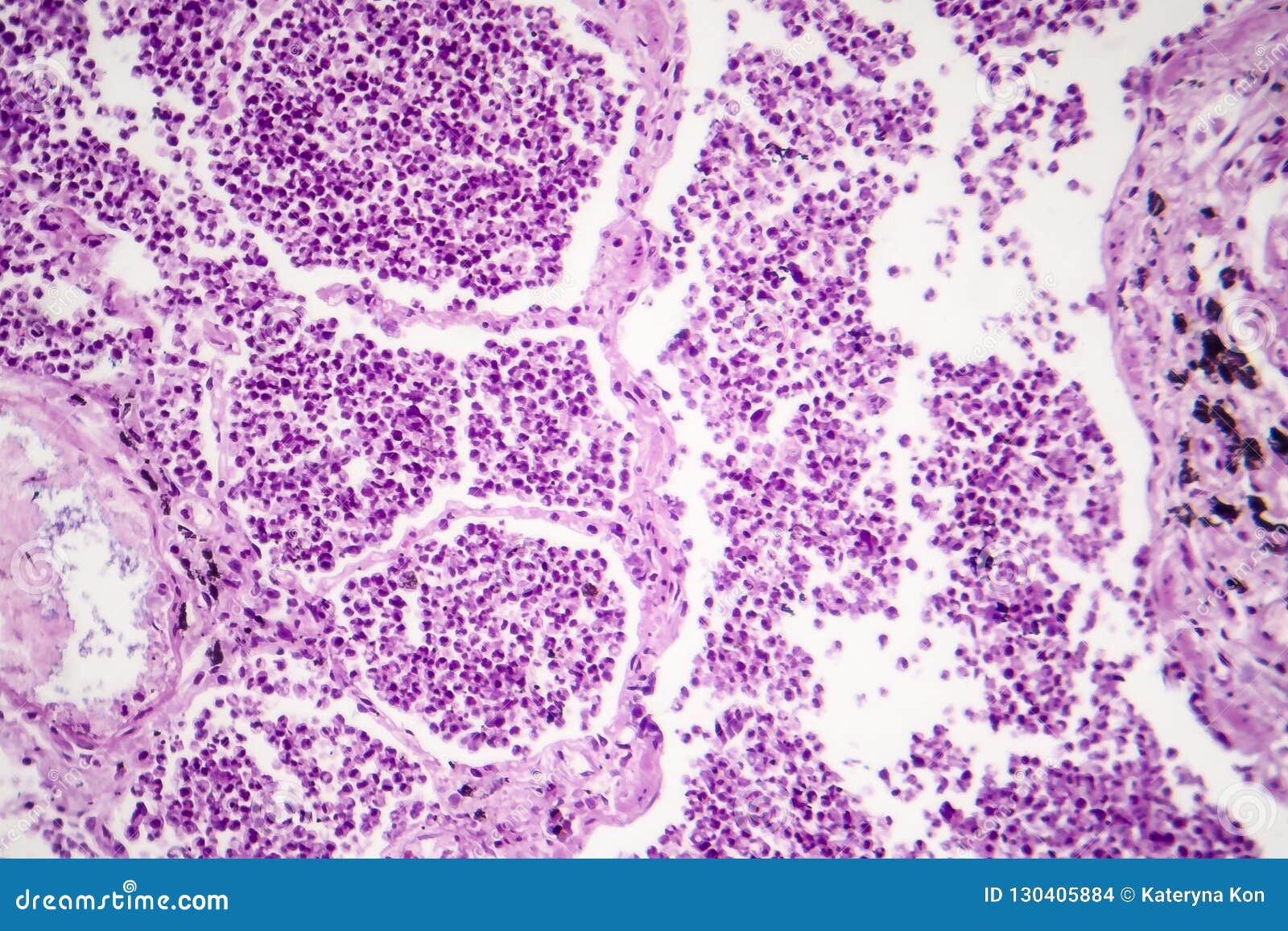 Lobar Pneumonia Histology