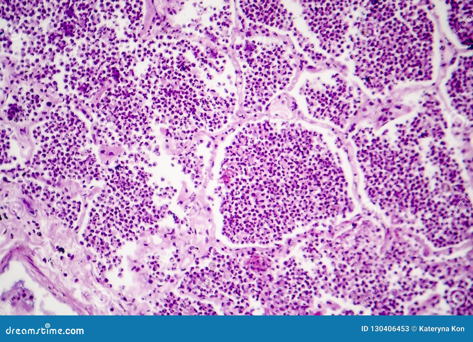 Lobar Pneumonia, Grey Hepatic Phase Stock Image - Image of infection ...