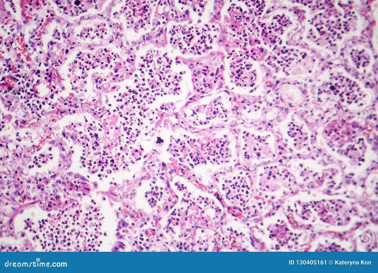 Lobar Pneumonia, Red Hepatic Phase Stock Image - Image of microscope ...