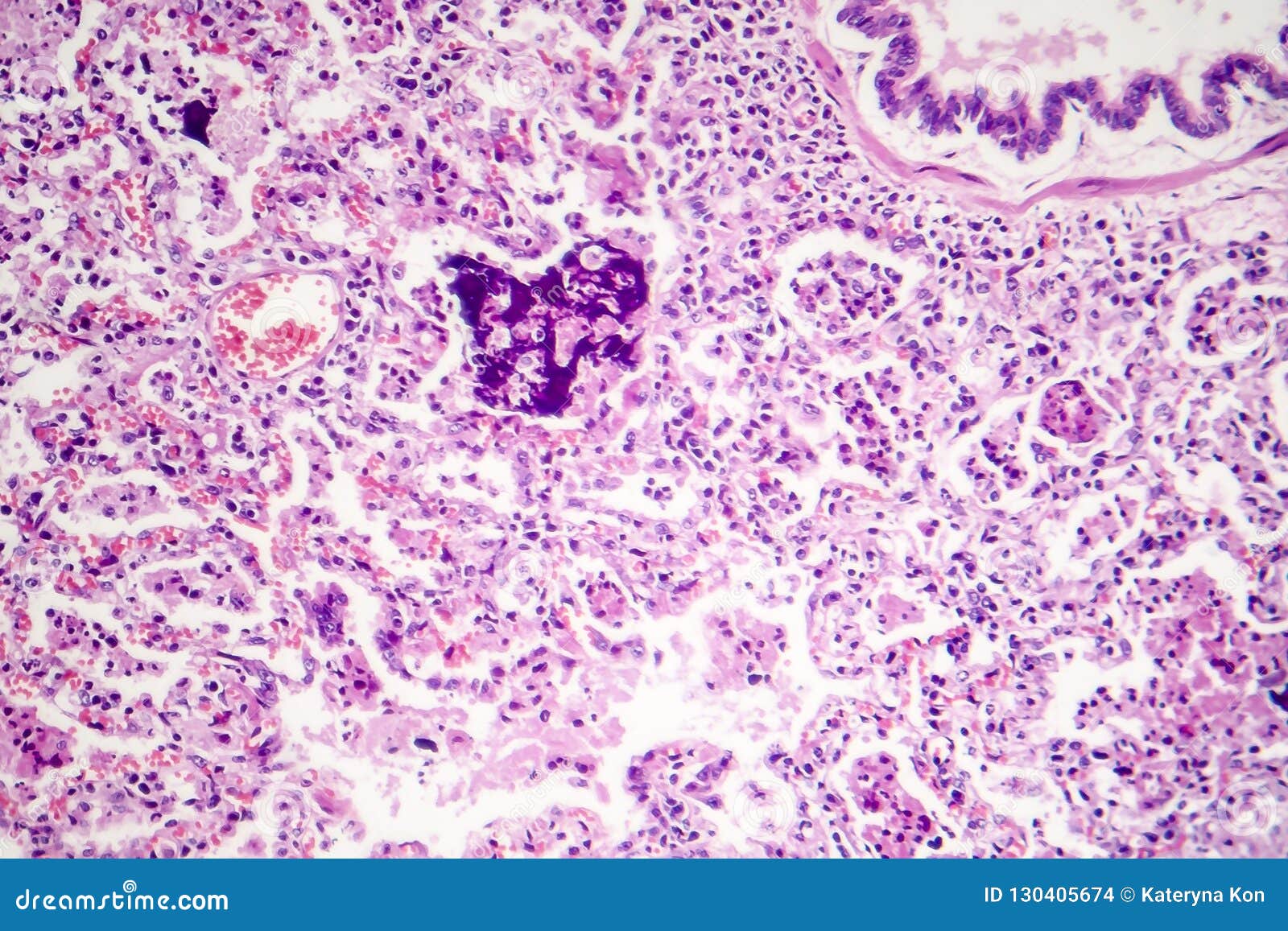 Lobar Pneumonia, Red Hepatic Phase Stock Photo - Image of pneumococcal ...