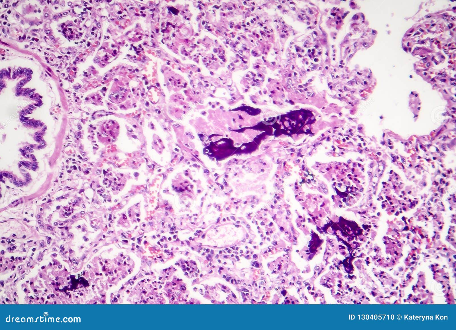 Lobar Pneumonia Histology