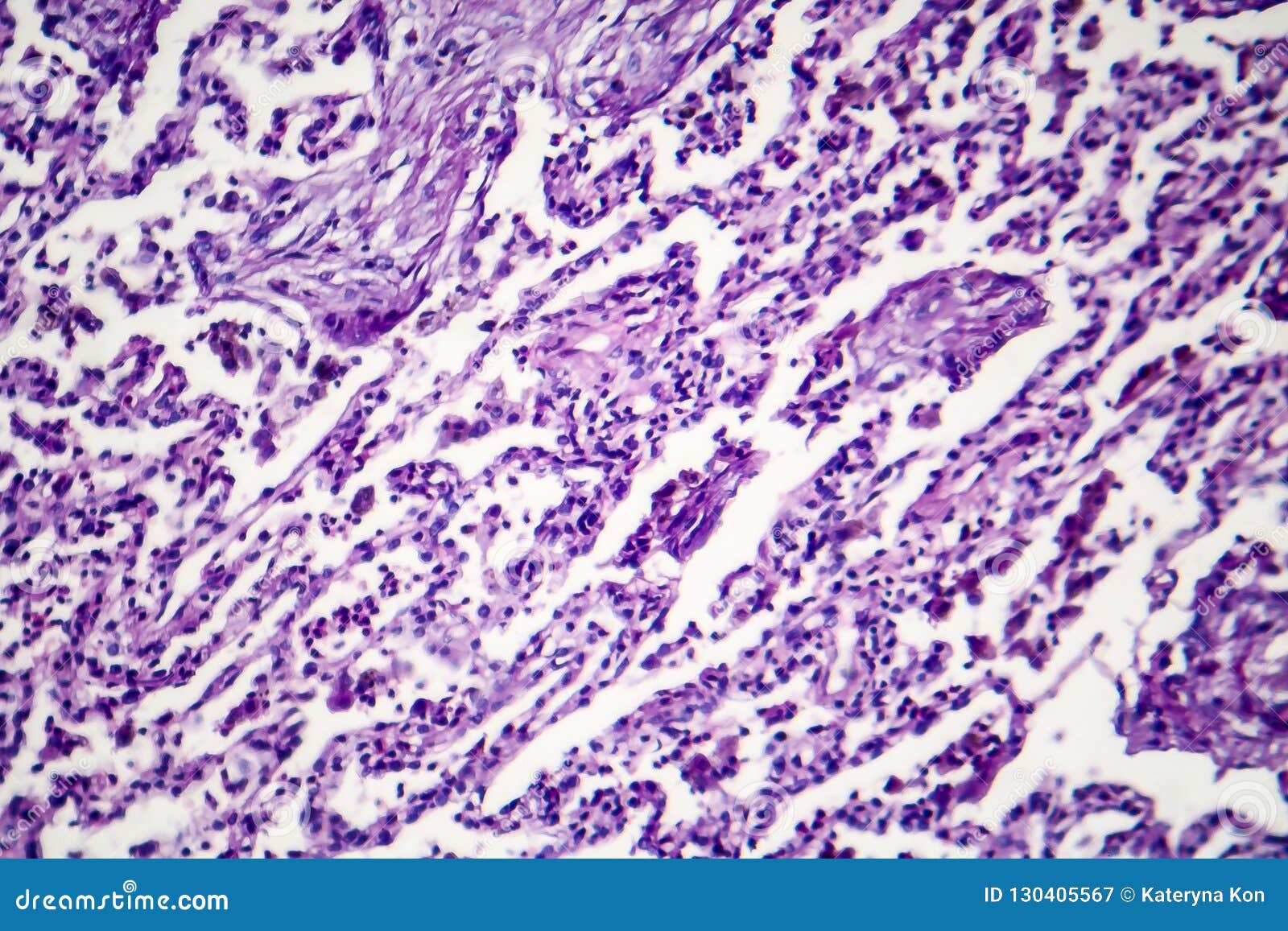 Lobar Pneumonia, Resolution Period Stock Image - Image of medicine ...