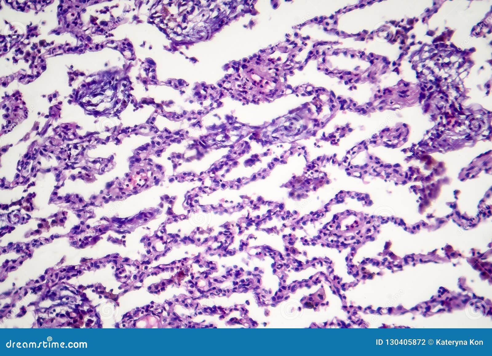 Lobar Pneumonia, Resolution Period Stock Photo - Image of lung ...