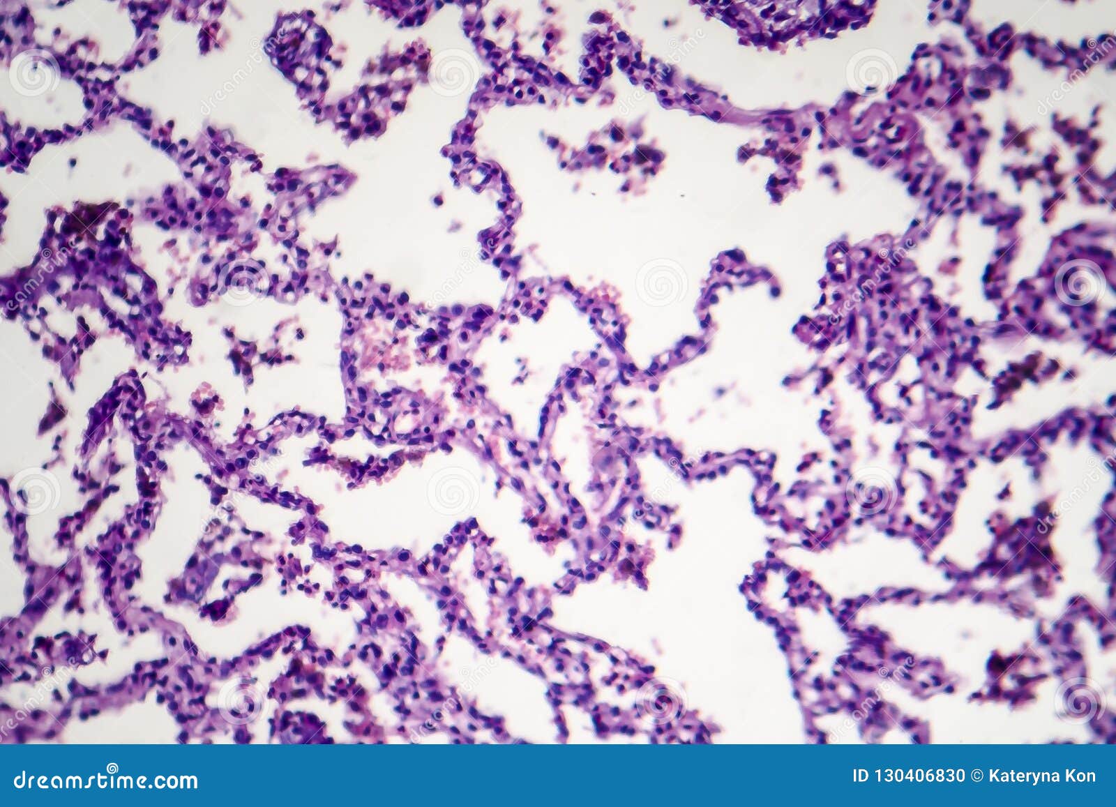 Lobar Pneumonia, Resolution Period Stock Photo - Image of histology ...