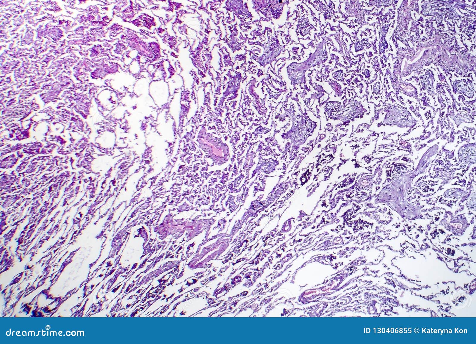 Lobar Pneumonia . Stock Image | CartoonDealer.com #81146167