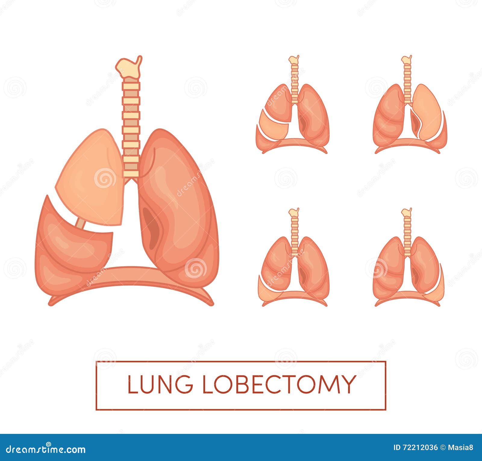 Lobectomia del polmone illustrazione di stock. Illustrazione di benigno ...