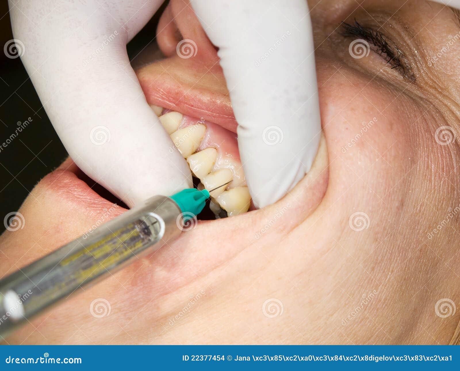 Local anesthesia stock photo. Image of prophylaxis, medical - 22377454