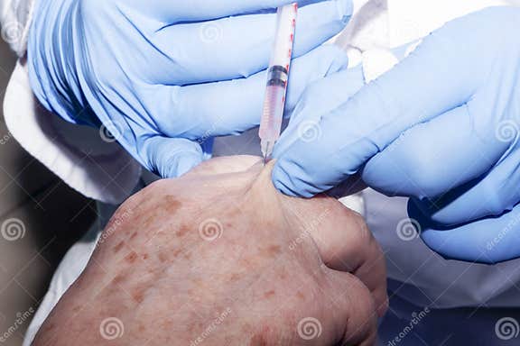 Local Anesthesia on the Hand Stock Image - Image of operation, needle ...