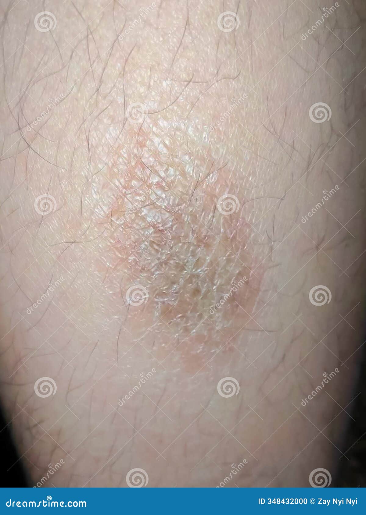 Localized Dermatitis on Skin Stock Photo - Image of fungal, dermatitis ...