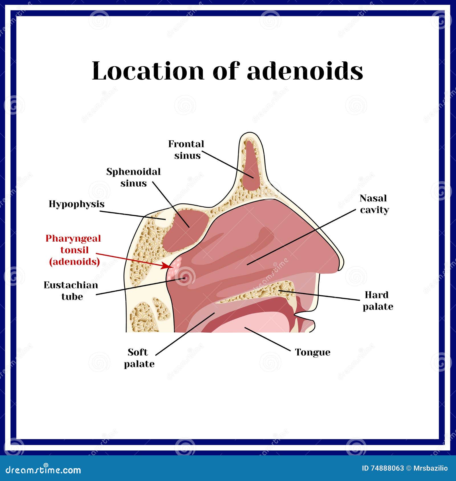 Enlarged Adenoid Glands Cartoon Vector | CartoonDealer.com #46045793 Enlarged Adenoid Glands Cartoon Vector | CartoonDealer.com #46045793