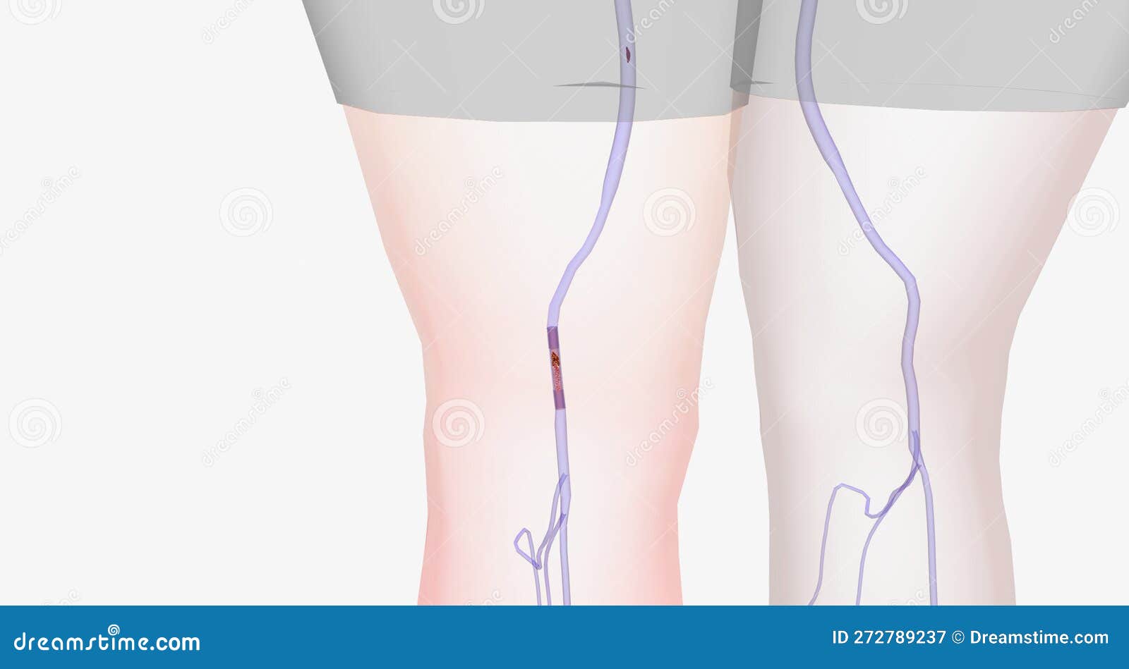 Location of Deep Vein Thrombosis Stock Illustration - Illustration of ...