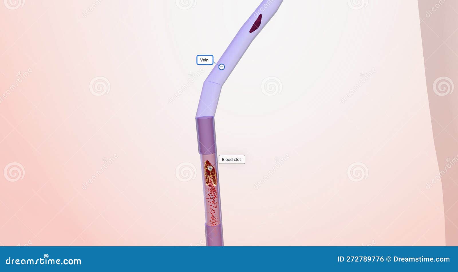 Location of Deep Vein Thrombosis Stock Illustration - Illustration of ...