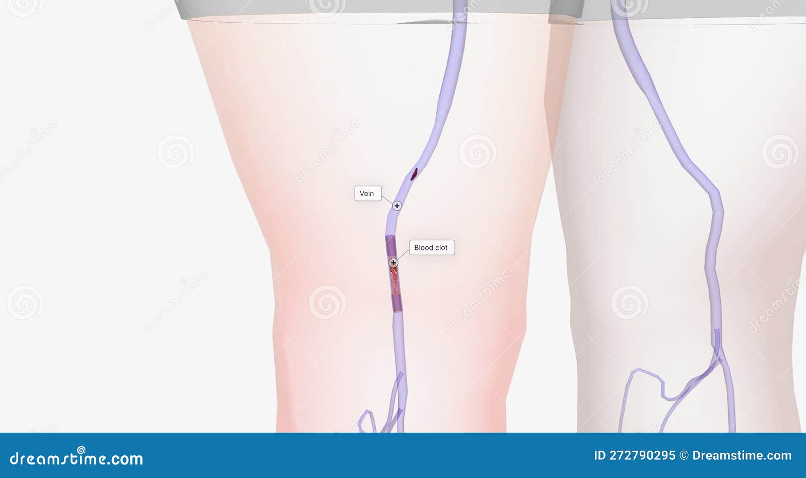Location of Deep Vein Thrombosis Stock Illustration - Illustration of ...