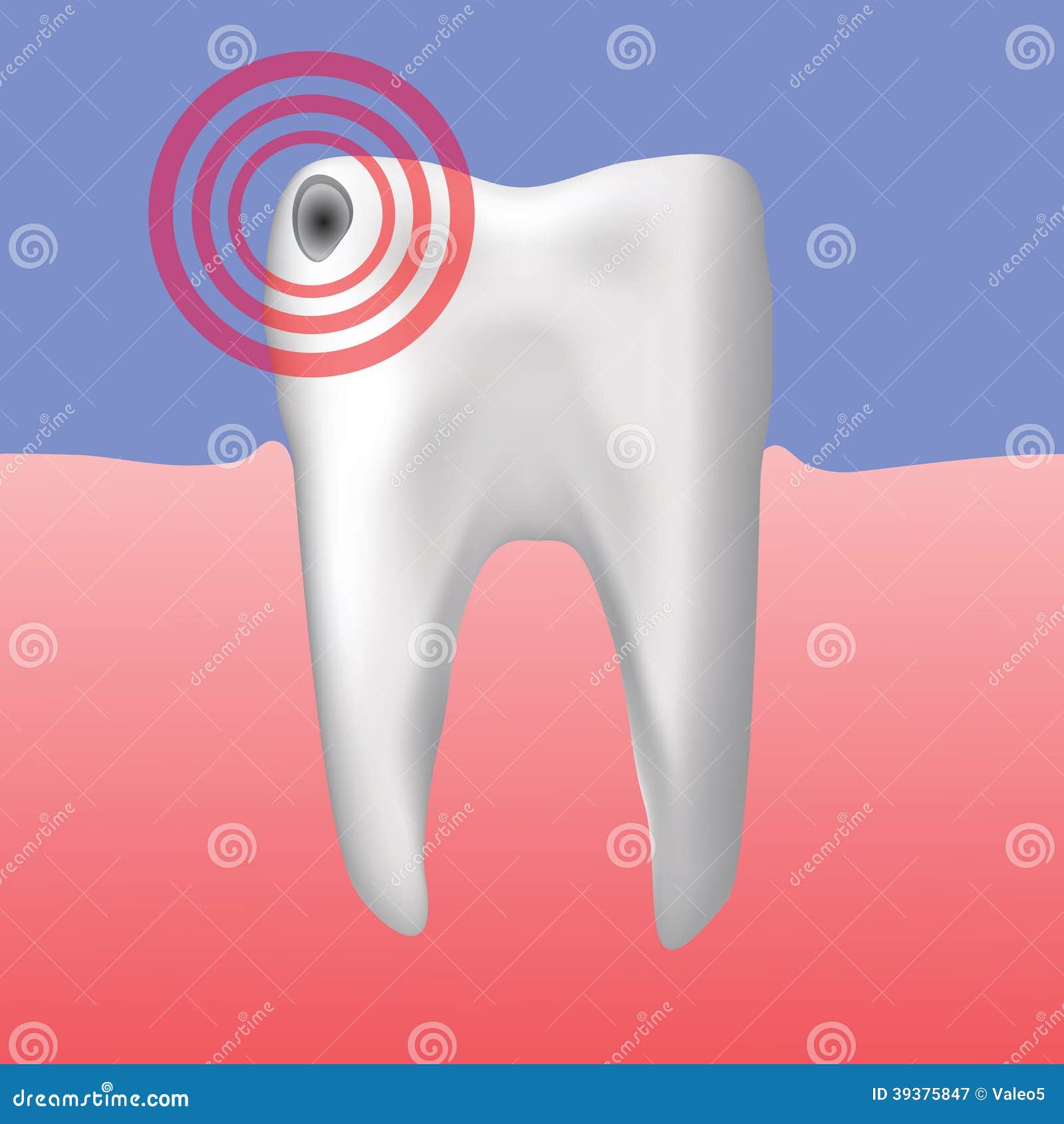 Loch im Zahn vektor abbildung. Illustration von ikone - 39375847