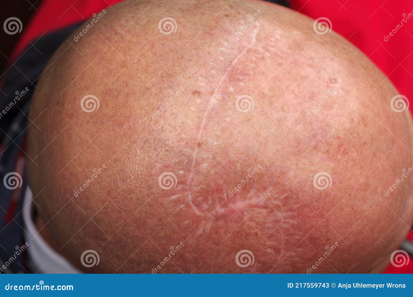 A Long Cicatrix Over the Head Stock Image - Image of cicatrix, recovery ...