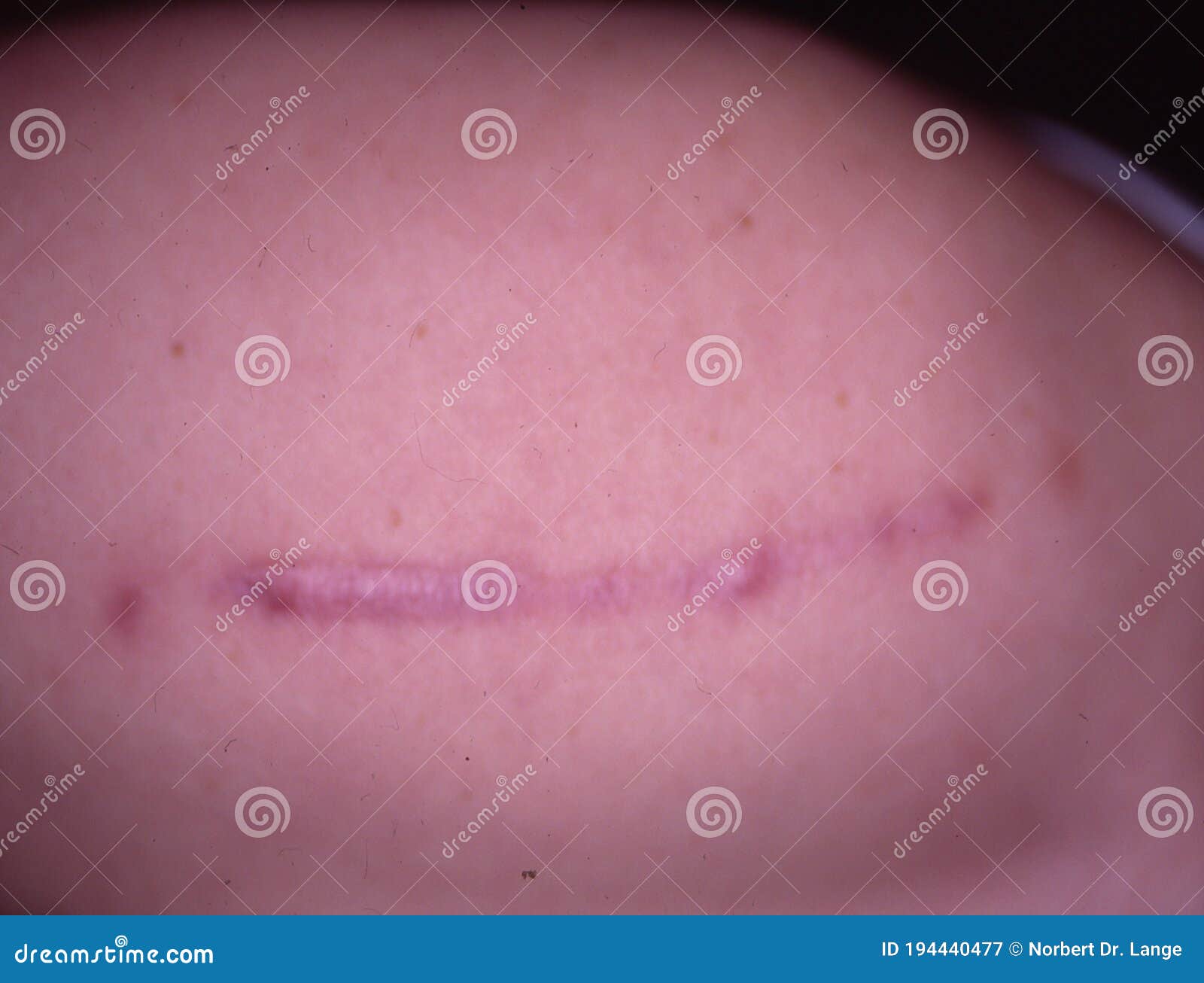 Long Scar On The Skin Stock Image | CartoonDealer.com #194440477