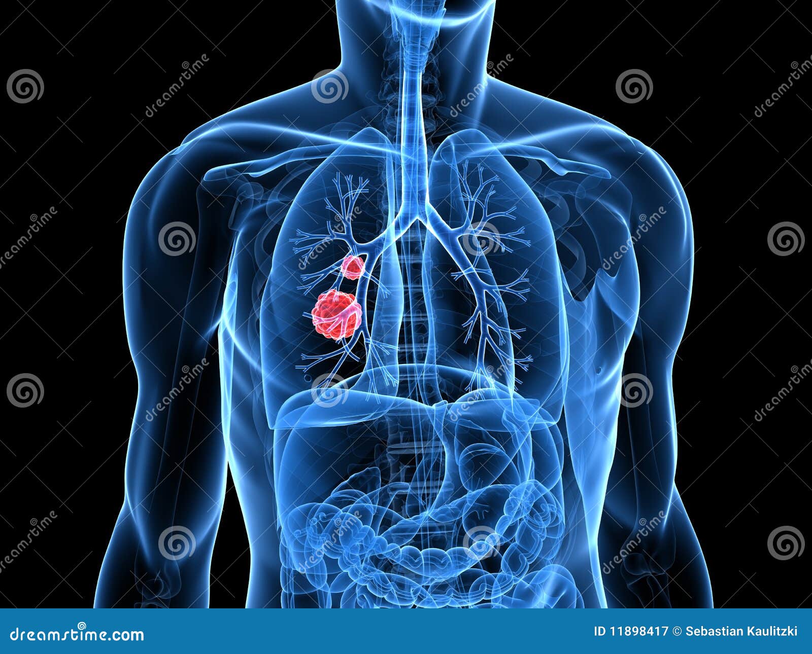 Longkanker stock illustratie. Illustration of kanker - 11898417