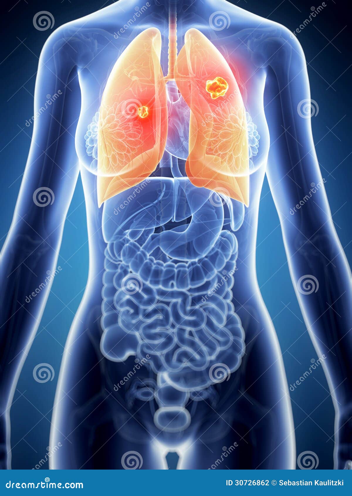 Longkanker stock illustratie. Illustration of menselijk - 30726862