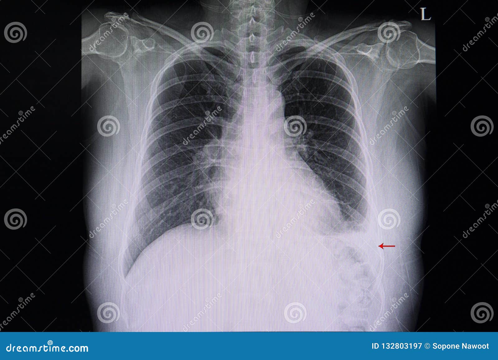 Longontsteking stock afbeelding. Image of lager, diagnose - 132803197