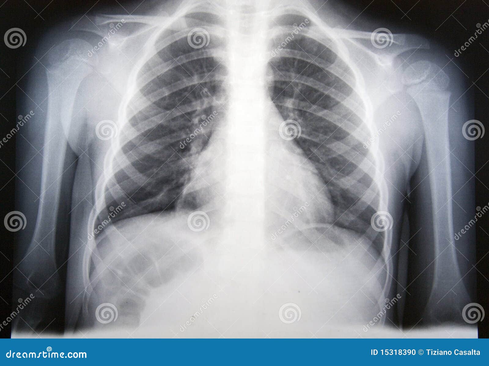 Longontsteking stock foto. Image of bronchitis, buik - 15318390