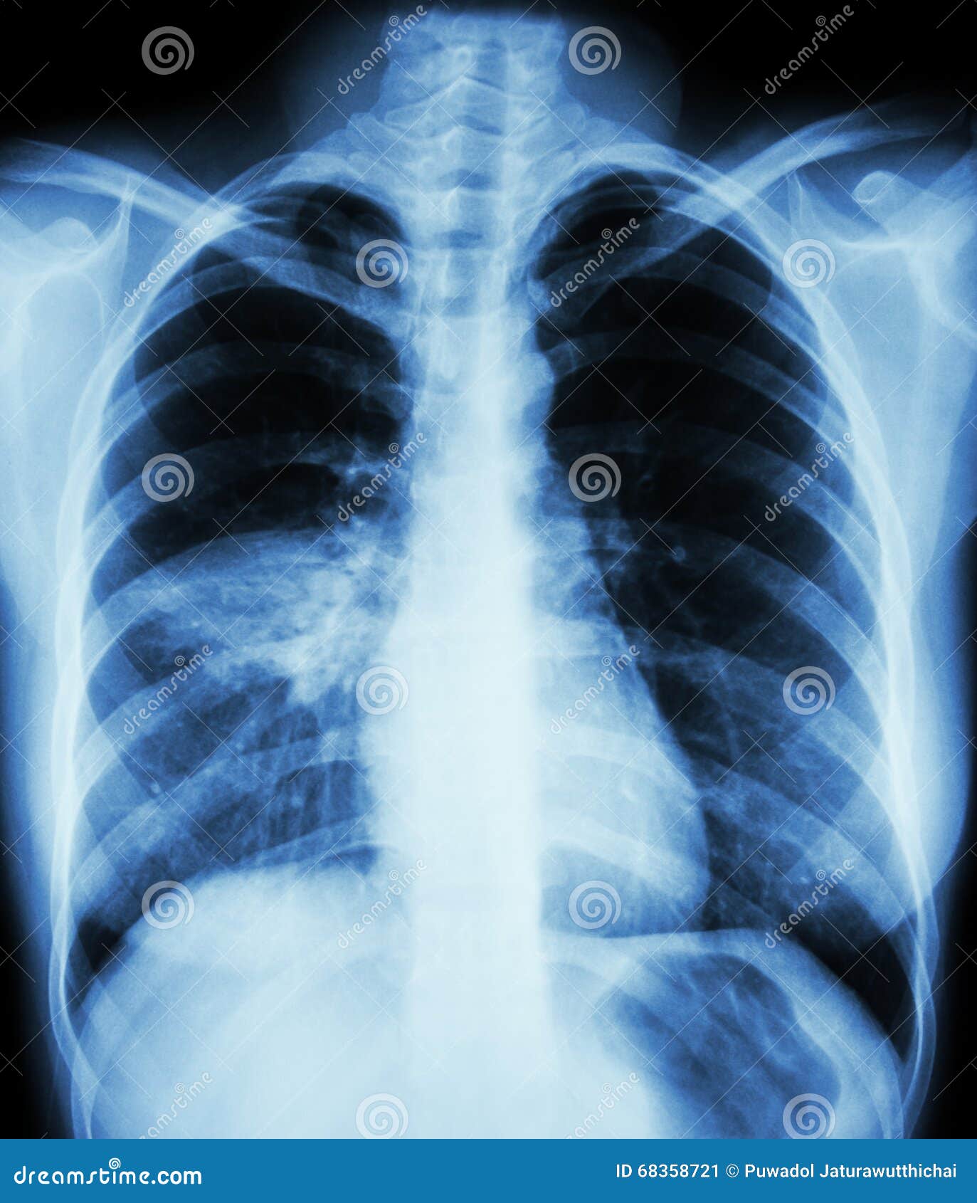 Longontsteking stock afbeelding. Image of borst, geduldig - 68358721