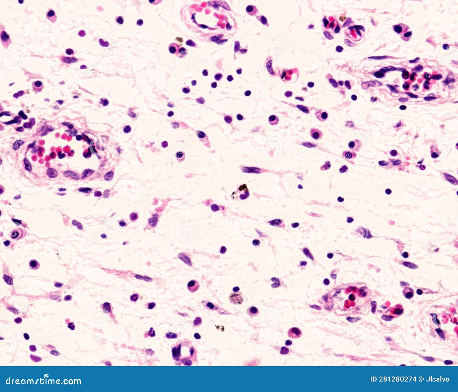 Loose Connective Tissue. Chronic Inflammation Stock Photo - Image of ...