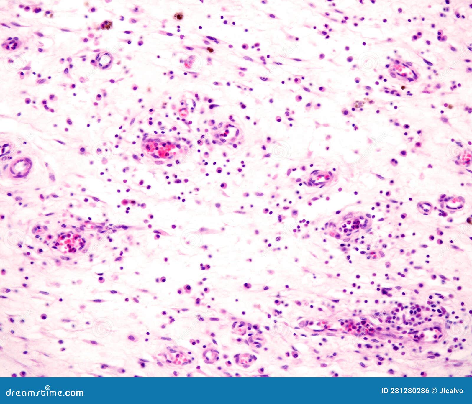 Loose Connective Tissue. Chronic Inflammation Stock Photo - Image of ...