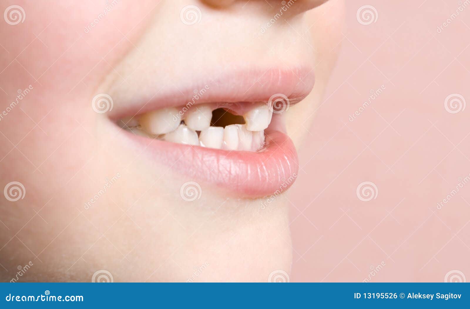 Lost a tooth stock photo. Image of lips, childhood, dentist - 13195526