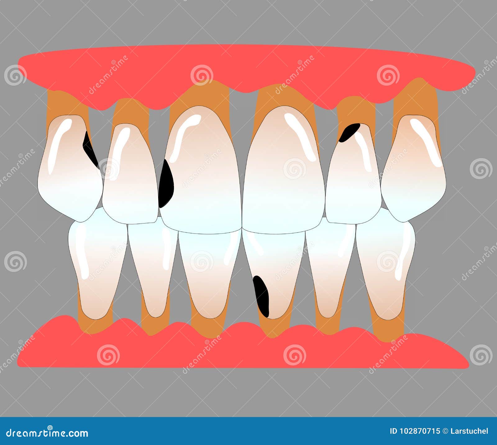 Human Anterior Teeth with Periodontitis and Caries Stock Illustration ...