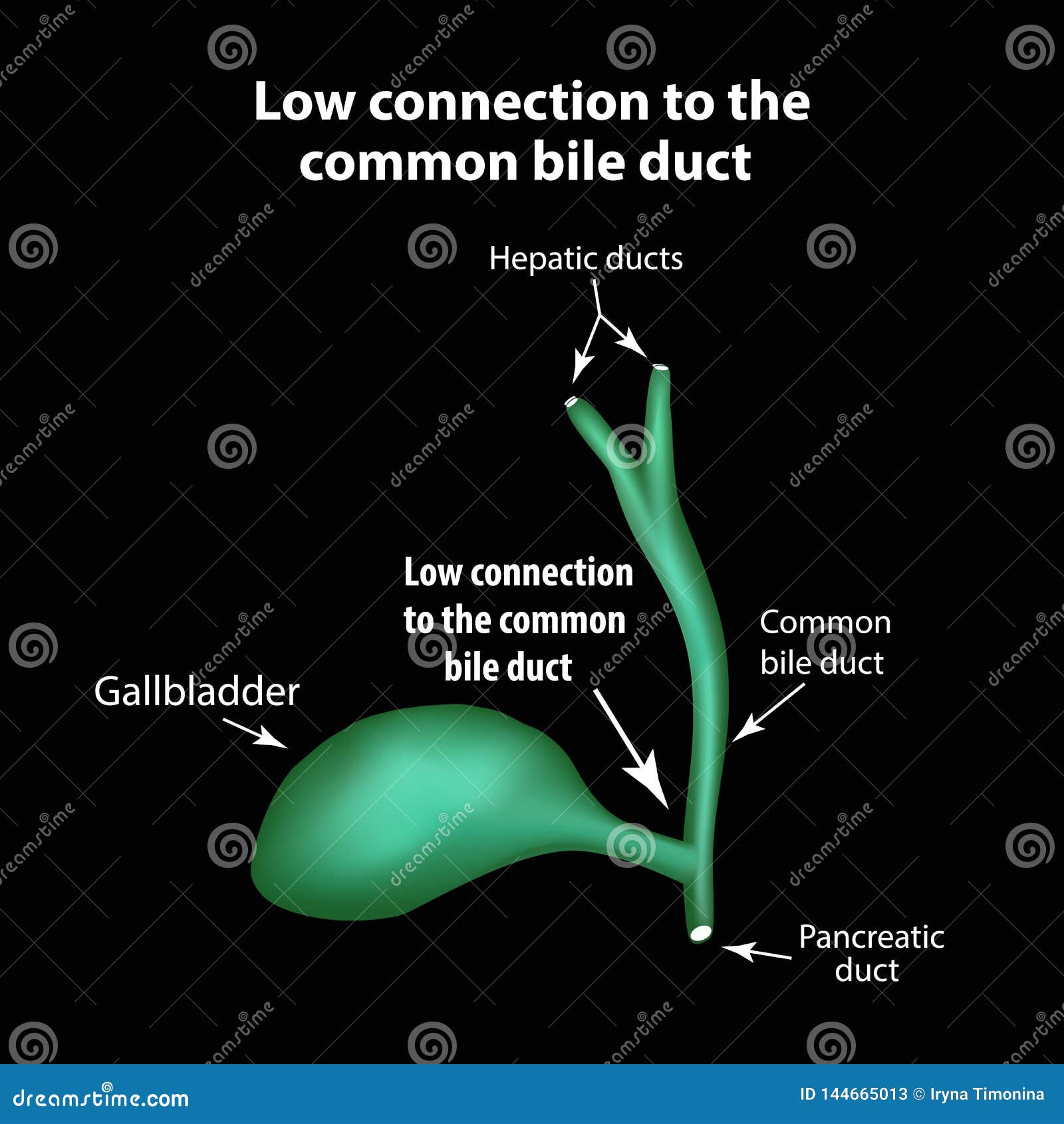 Pathology Of The Gallbladder The Bend Of The Gallbladder Set Vector