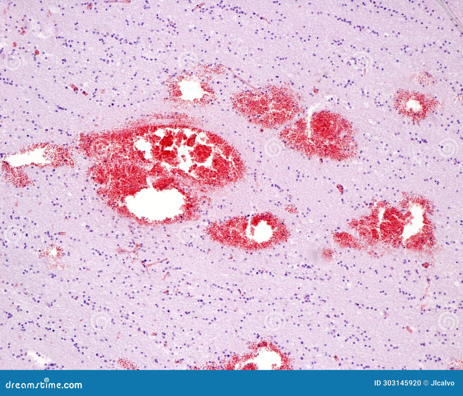 Cerebral microhemorrhages stock photo. Image of body - 303145920