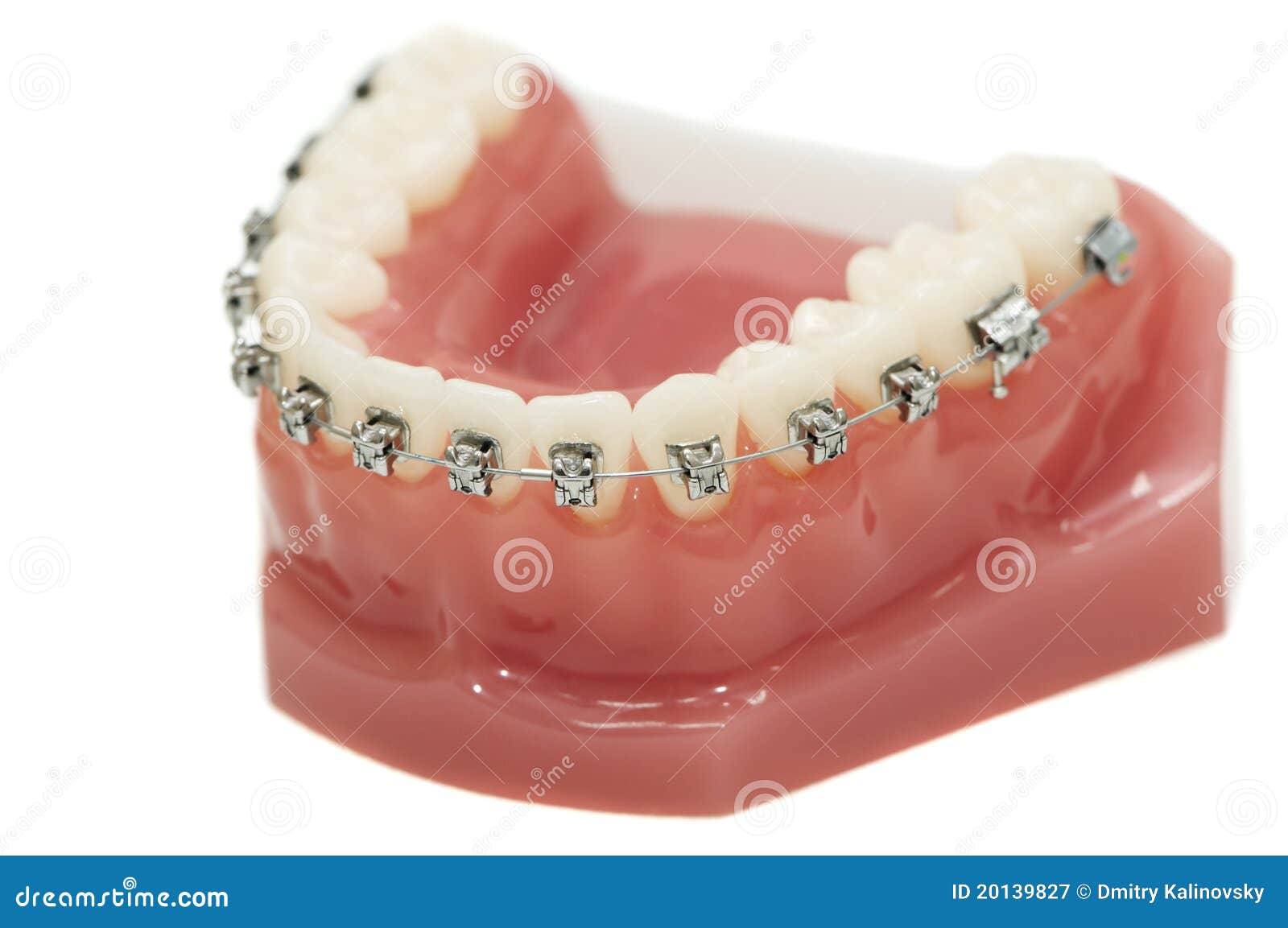 Lower Dental Jaw Bracket Braces Stock Image - Image of orthodontist ...