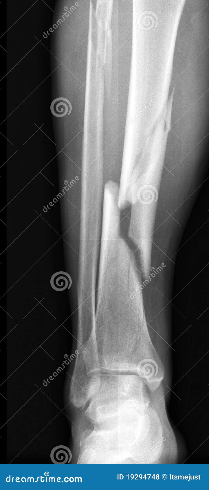 Lower leg fracture stock photo. Image of injury, trauma - 19294748