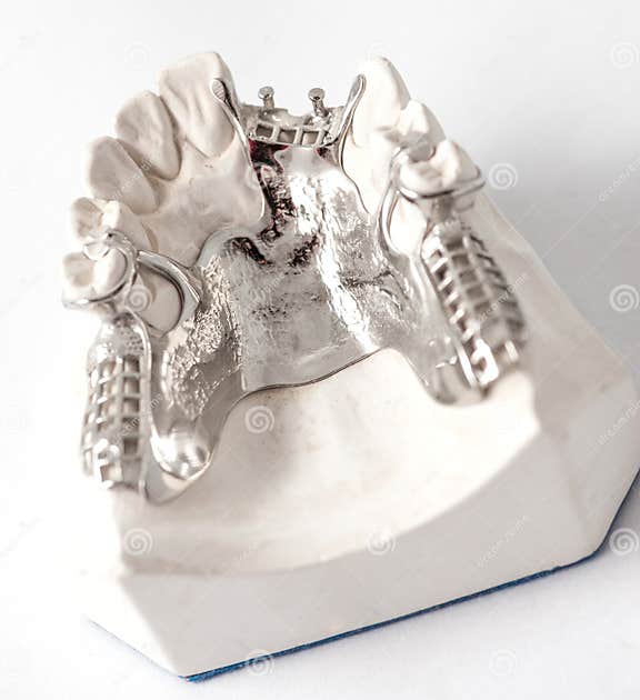 Lower Partial Denture with Attachments Stock Photo - Image of implants ...