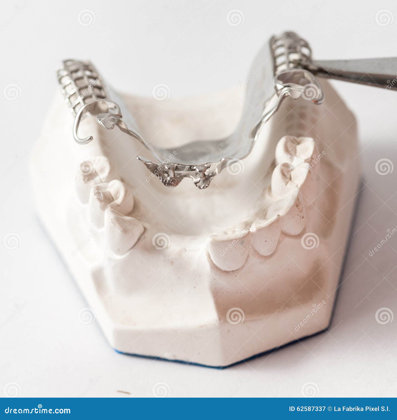 Lower Partial Denture with Attachments Stock Image - Image of ...