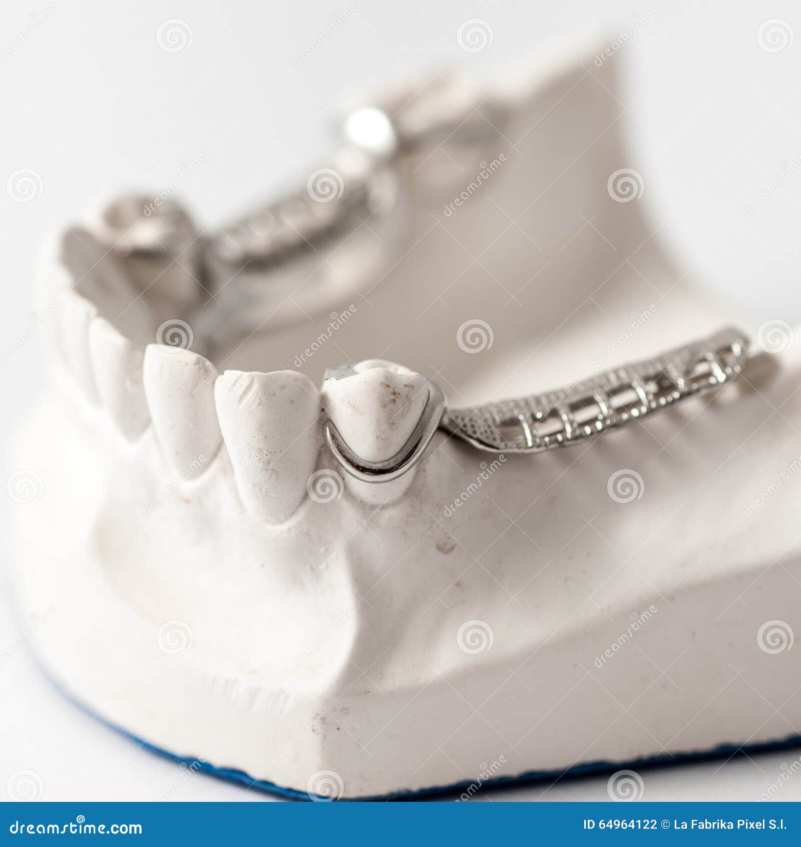 Lower Partial Denture with Attachments Stock Photo - Image of ...