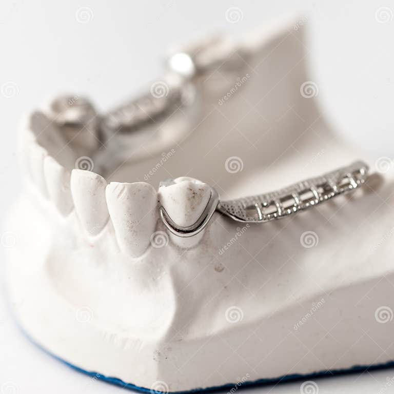 Lower Partial Denture with Attachments Stock Photo - Image of ...