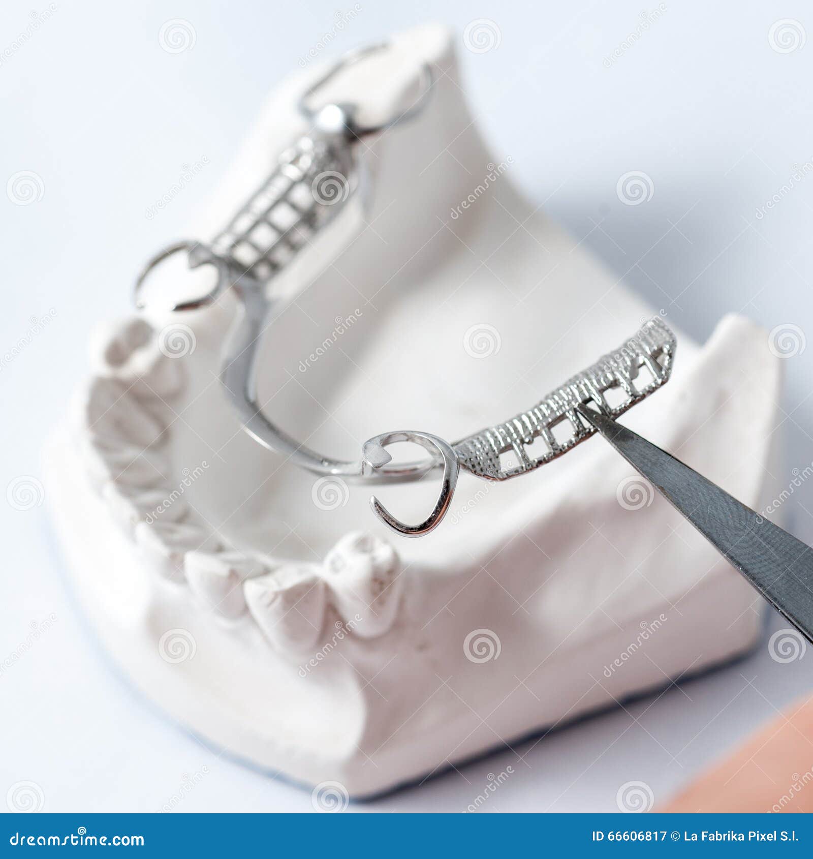 Lower Partial Denture With Attachments Royalty-Free Stock Photo ...