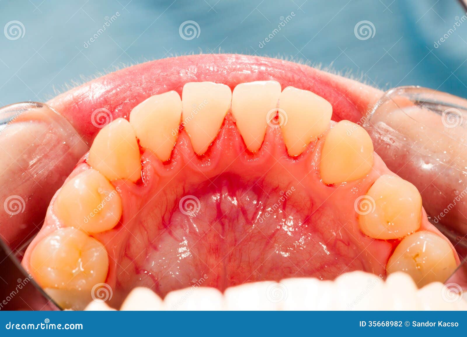 Lower Teeth stock photo. Image of cavity, aesthetic, medicine - 35668982
