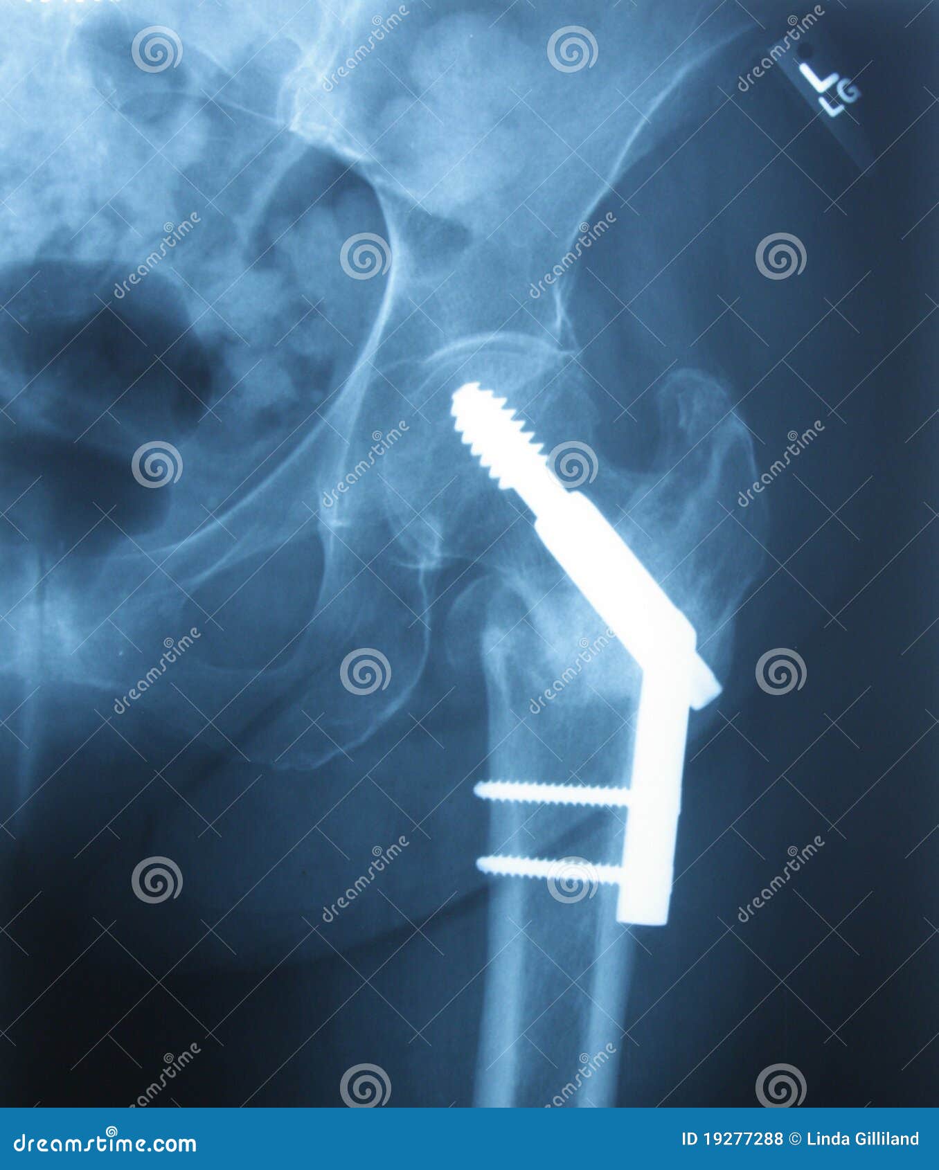 Lt Hip Prosthesis stock photo. Image of joint, bone, marker - 19277288