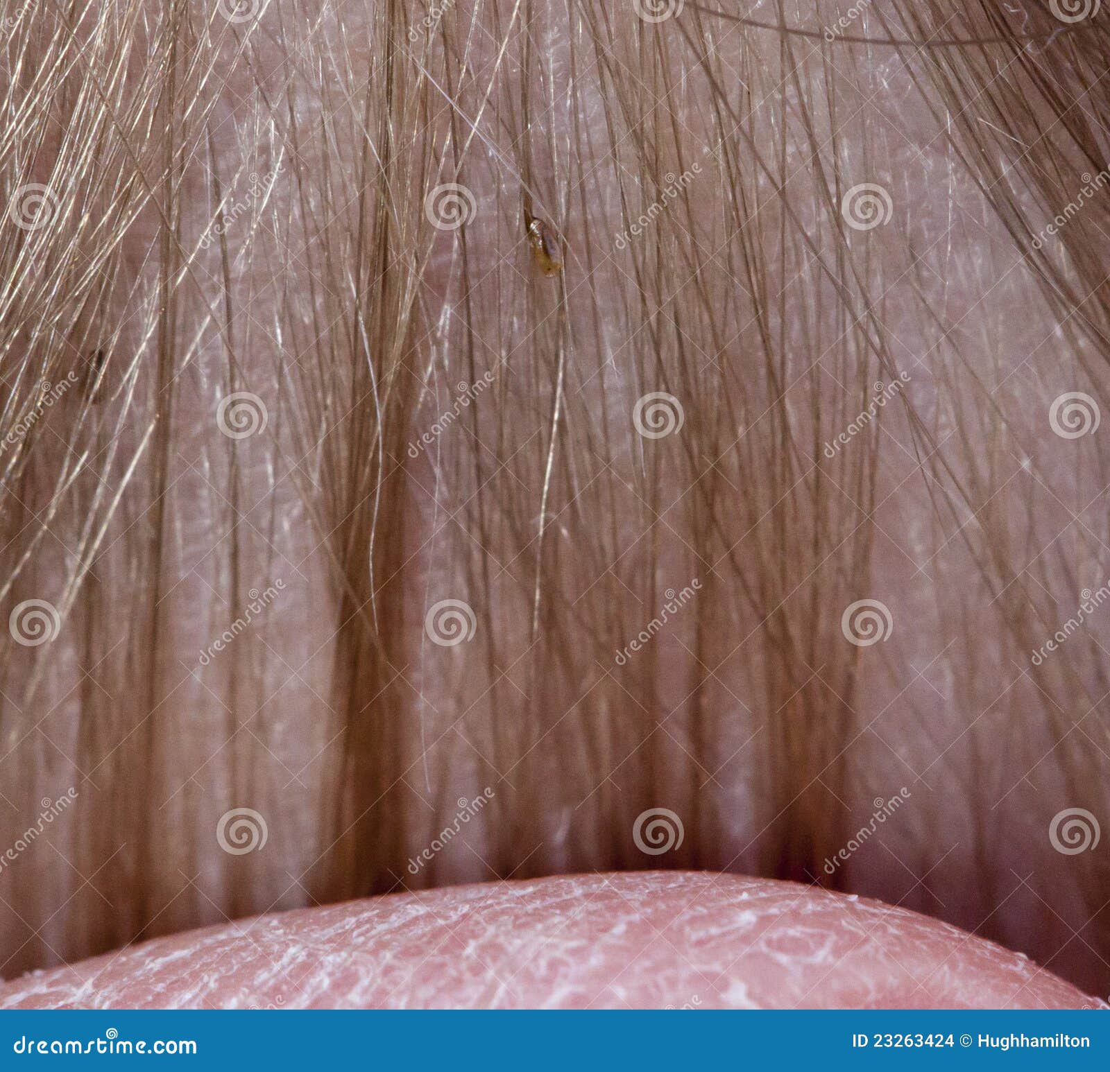 Luizen stock foto. Image of neten, haar, teistering, kinderen - 23263424