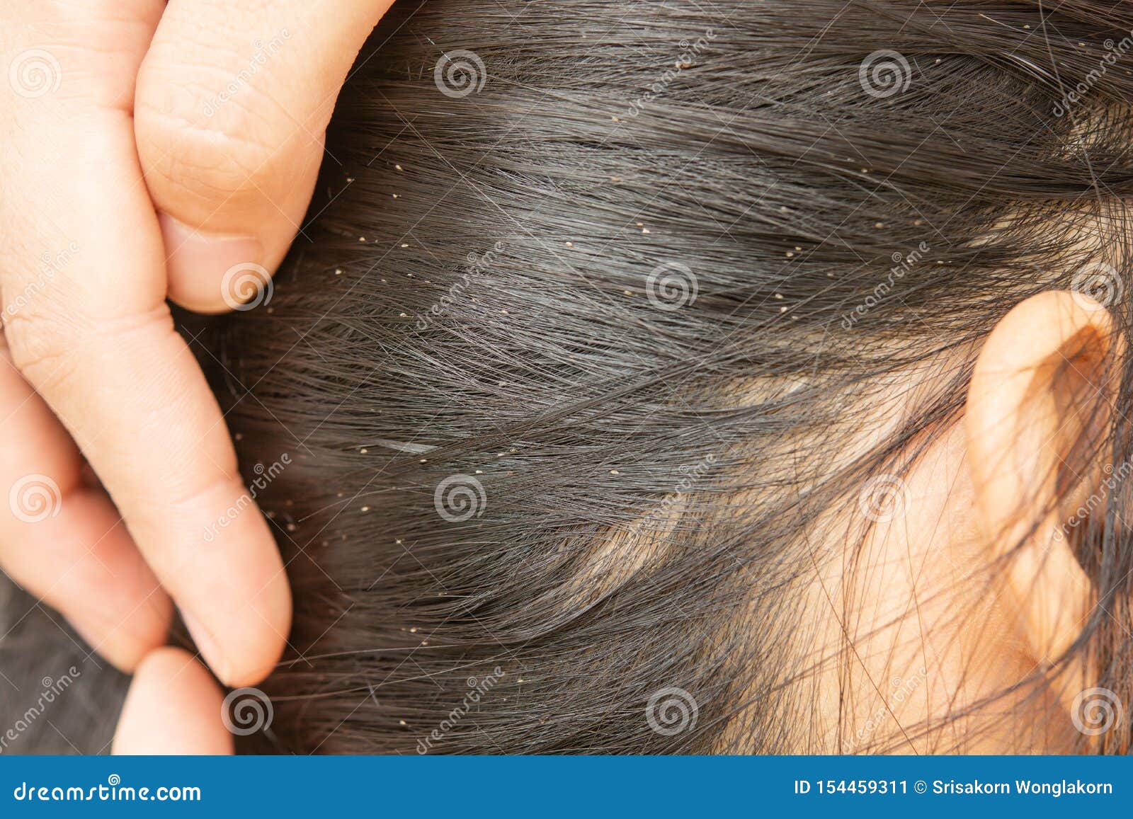 Luizen in haar en kam stock afbeelding. Image of neet - 154459311