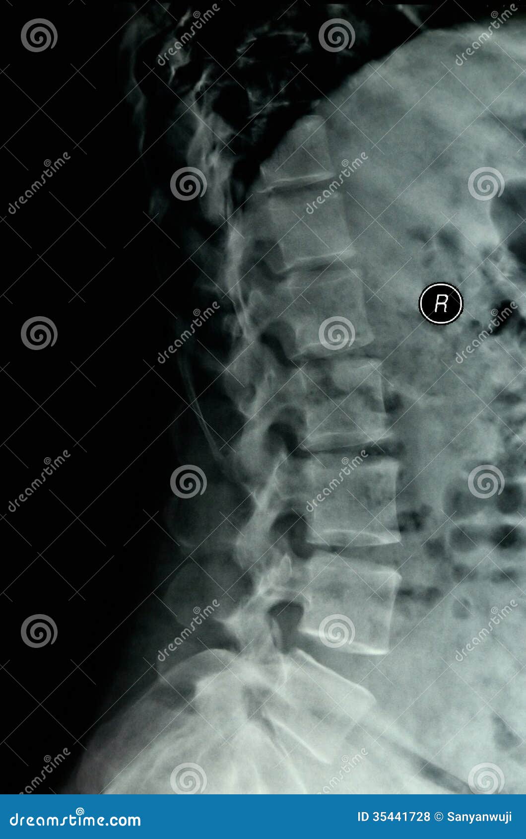Lumbar lateral x-rays stock photo. Image of spine, body - 35441728