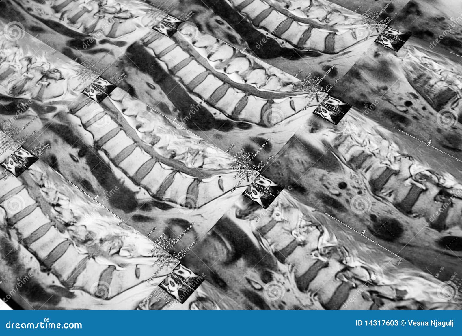 Lumbar spine MR (MRI) stock image. Image of back, herniation - 14317603