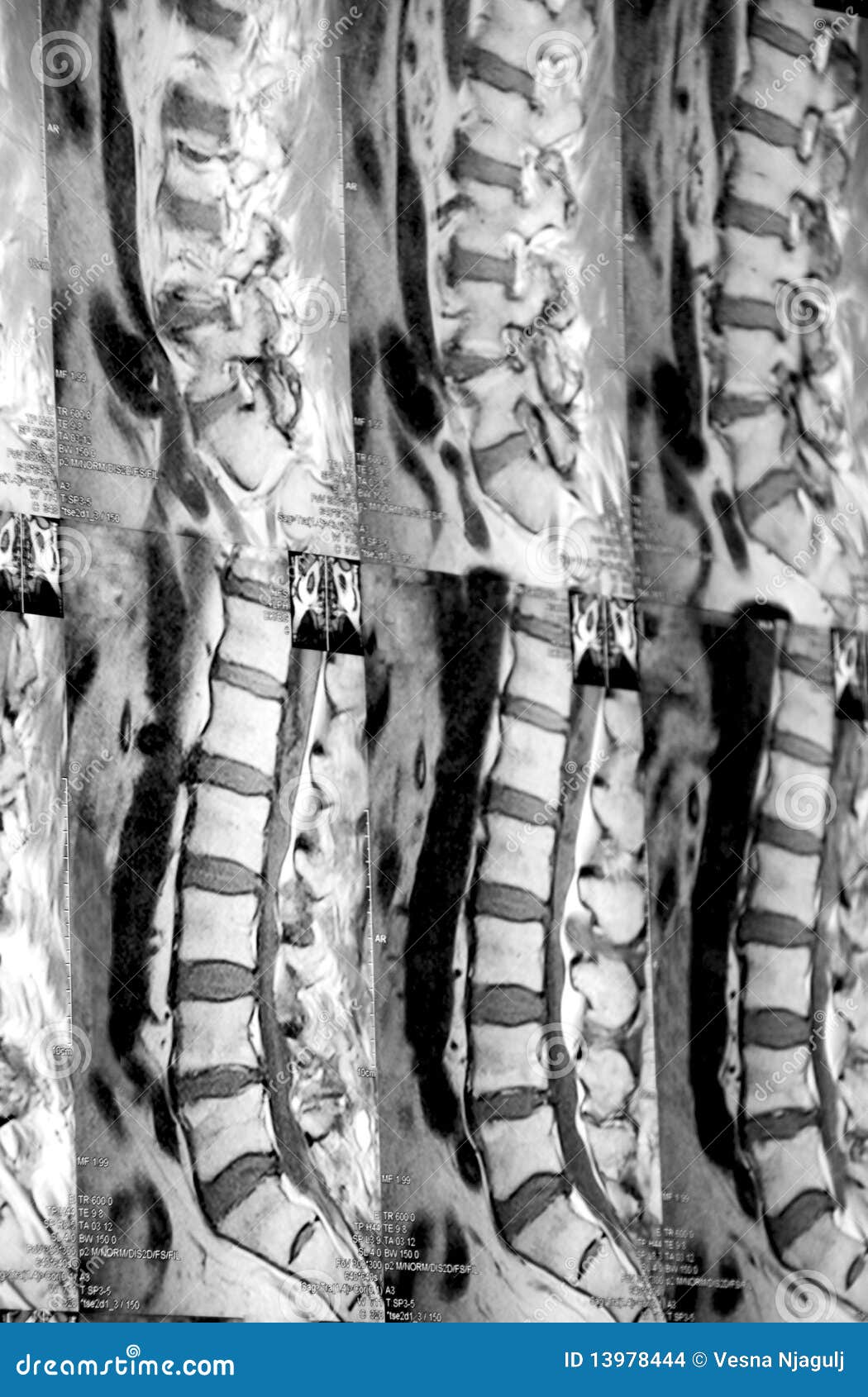 Lumbar spine MRI stock photo. Image of disk, medical - 13978444