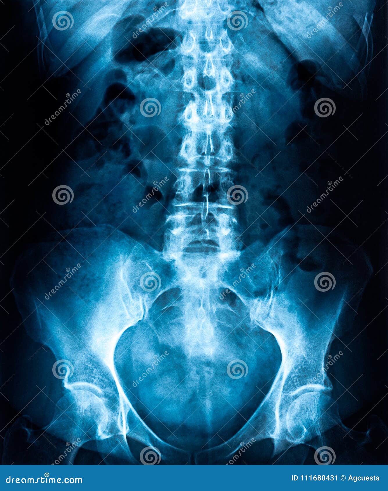 Lumbar Spine Xray Anatomy
