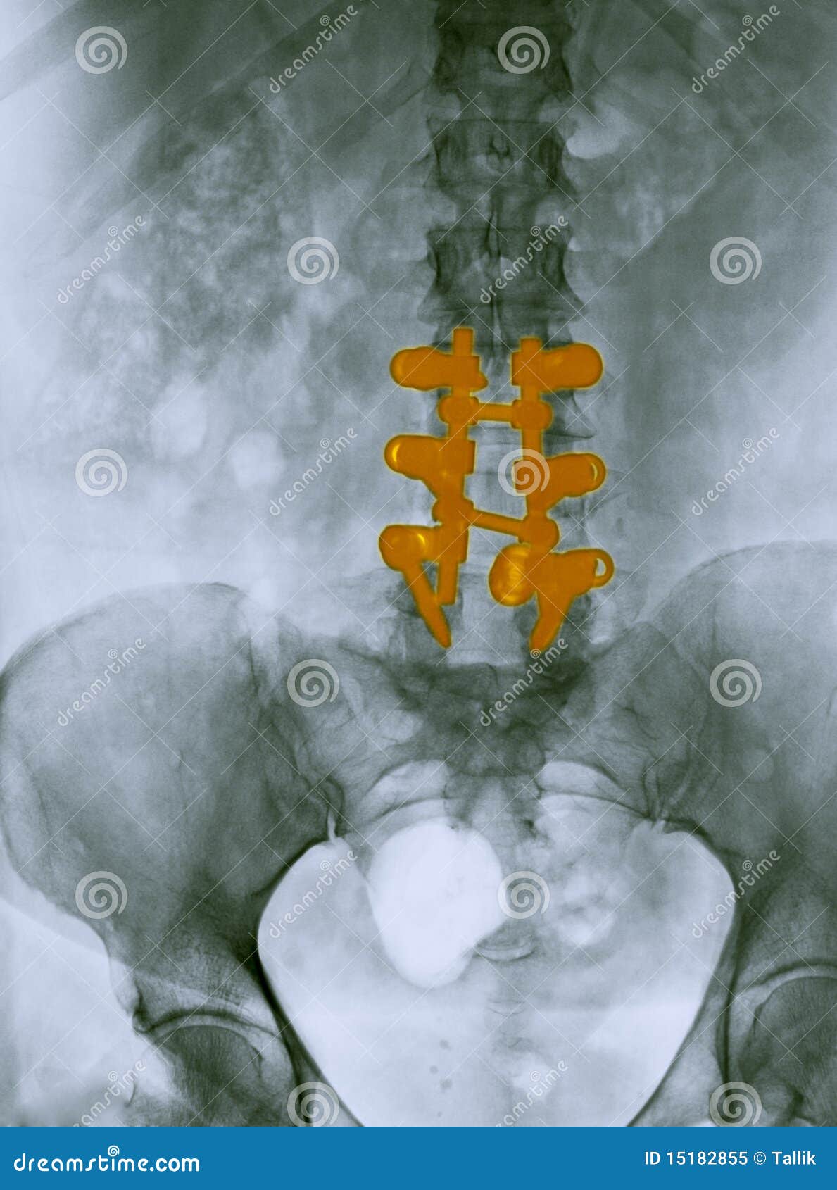 Lumbar Spine X-ray Showing A Spinal Fusion Royalty-Free Stock ...